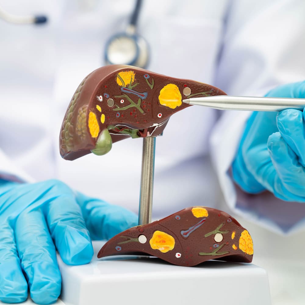 Liver Fibrosis and Cirrhosis Treatment in Singapore
